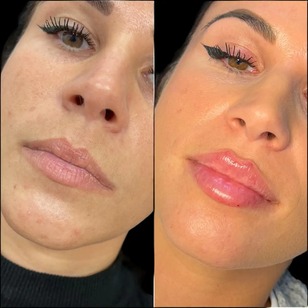 Safe and Effective Dermal Fillers Treatment in Dubai - Regic Blogs